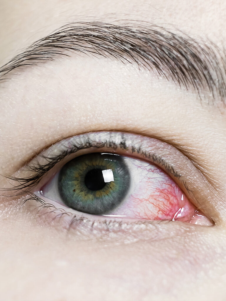 Dry Eye Syndrome - Shallotte Vision Care